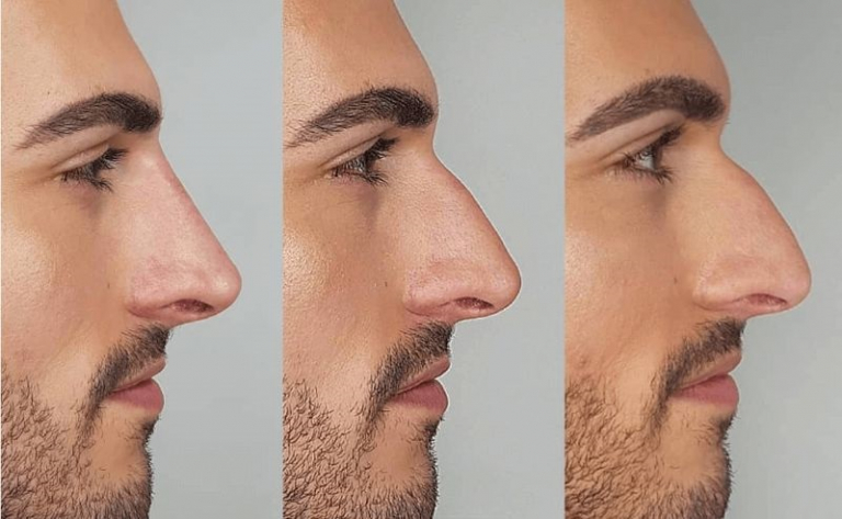 Bedeutung von Nasenformen: Ihre Nasenform sagt das über Sie aus!